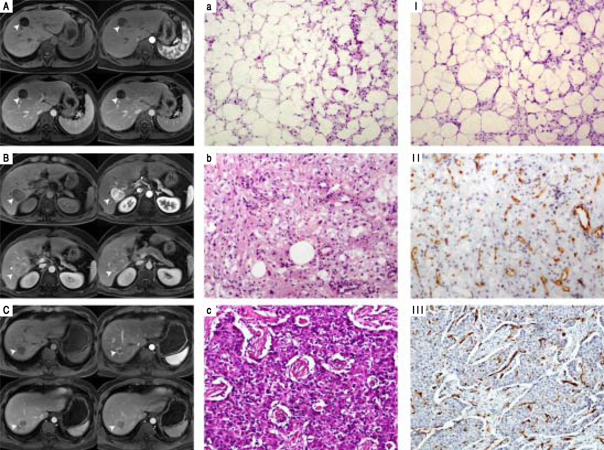 The Histopathological Features and CT/MRI Imaging Performances in ...
