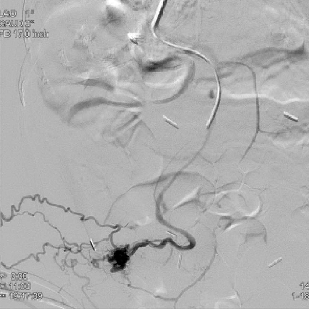 Case Series Regarding Parastomal Variceal Bleeding: Presentation and ...