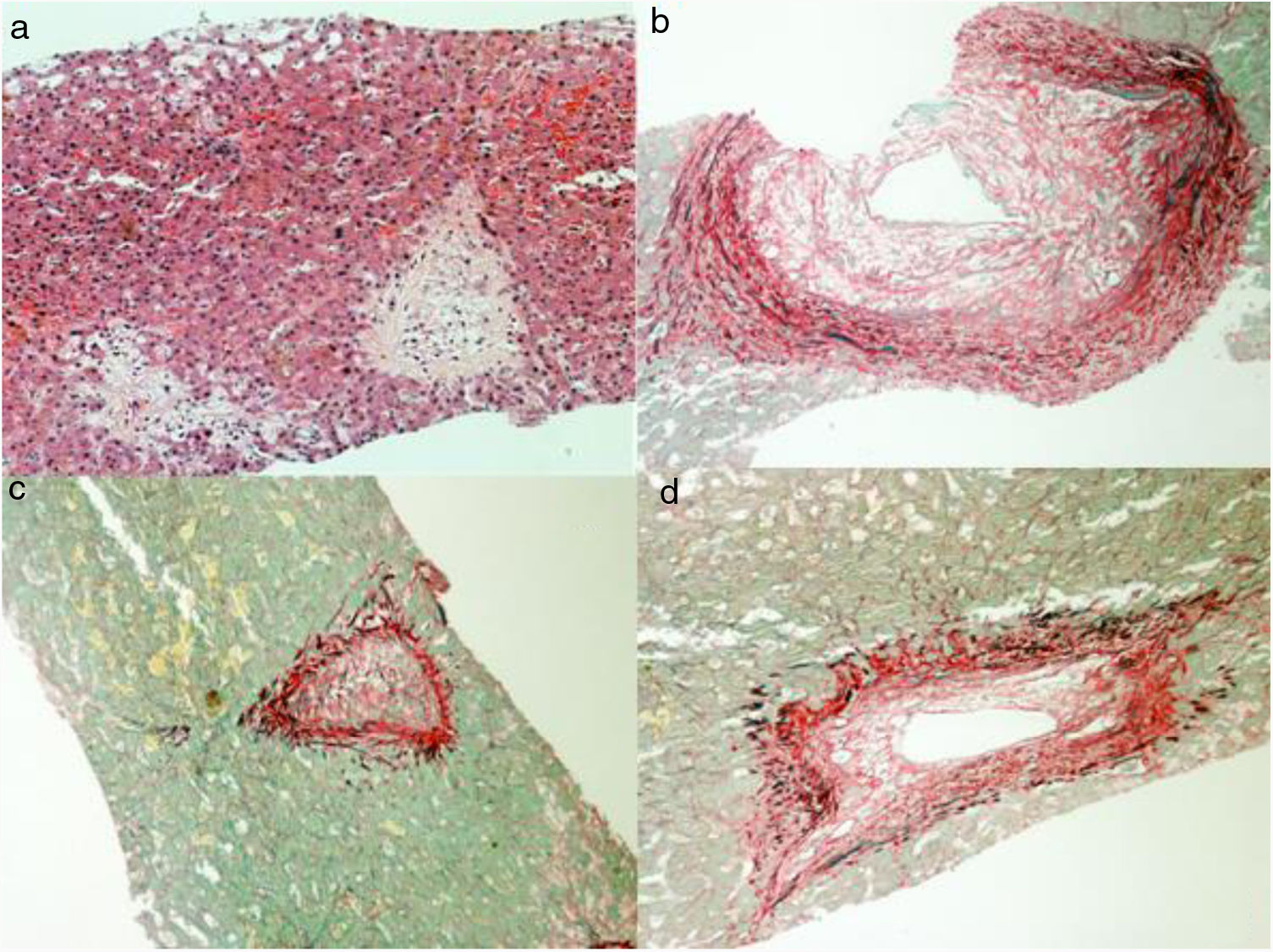 Sinusoidal obstruction syndrome secondary the intake of Senecio ...