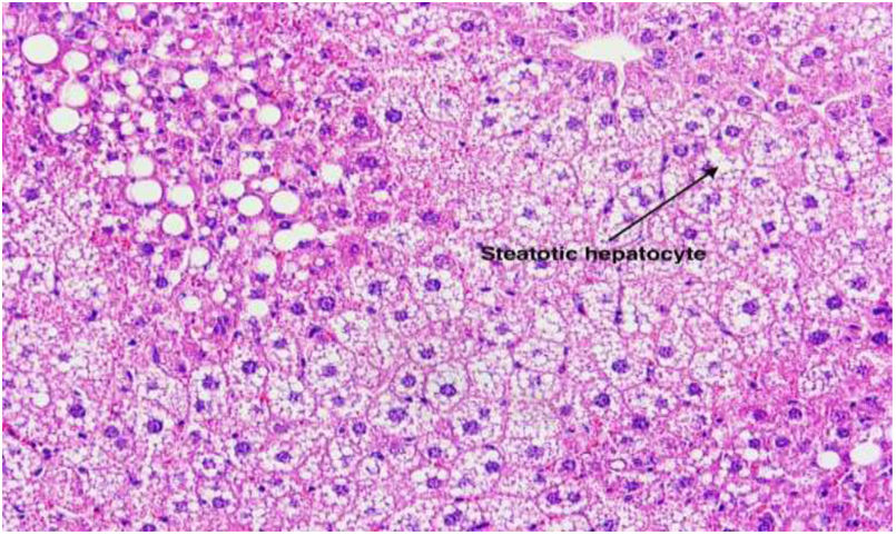 The effect of Tauroursodeoxycholic acid (TUDCA) and gut microbiota on ...