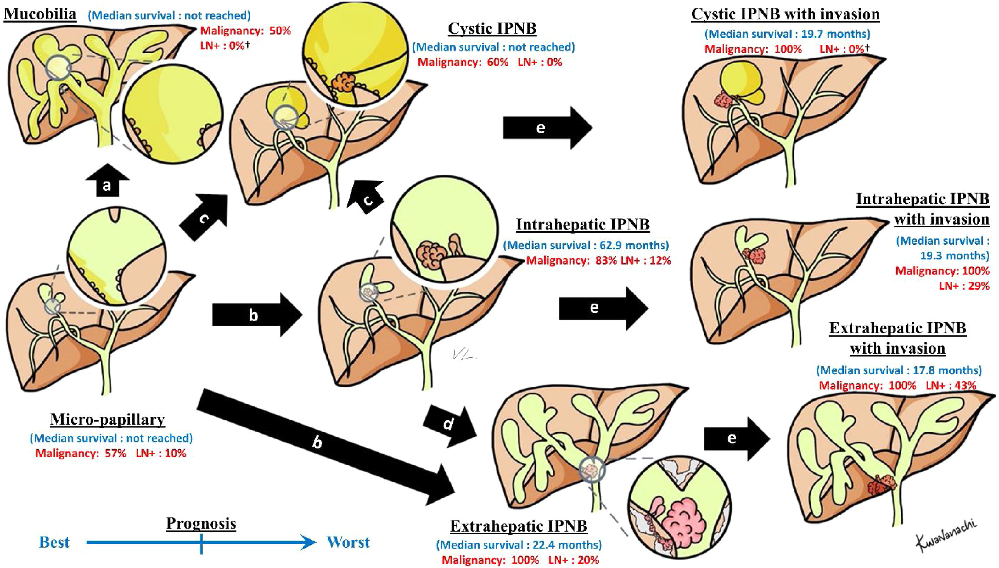 Progression of intraductal papillary neoplasm of the bile duct (IPNB ...