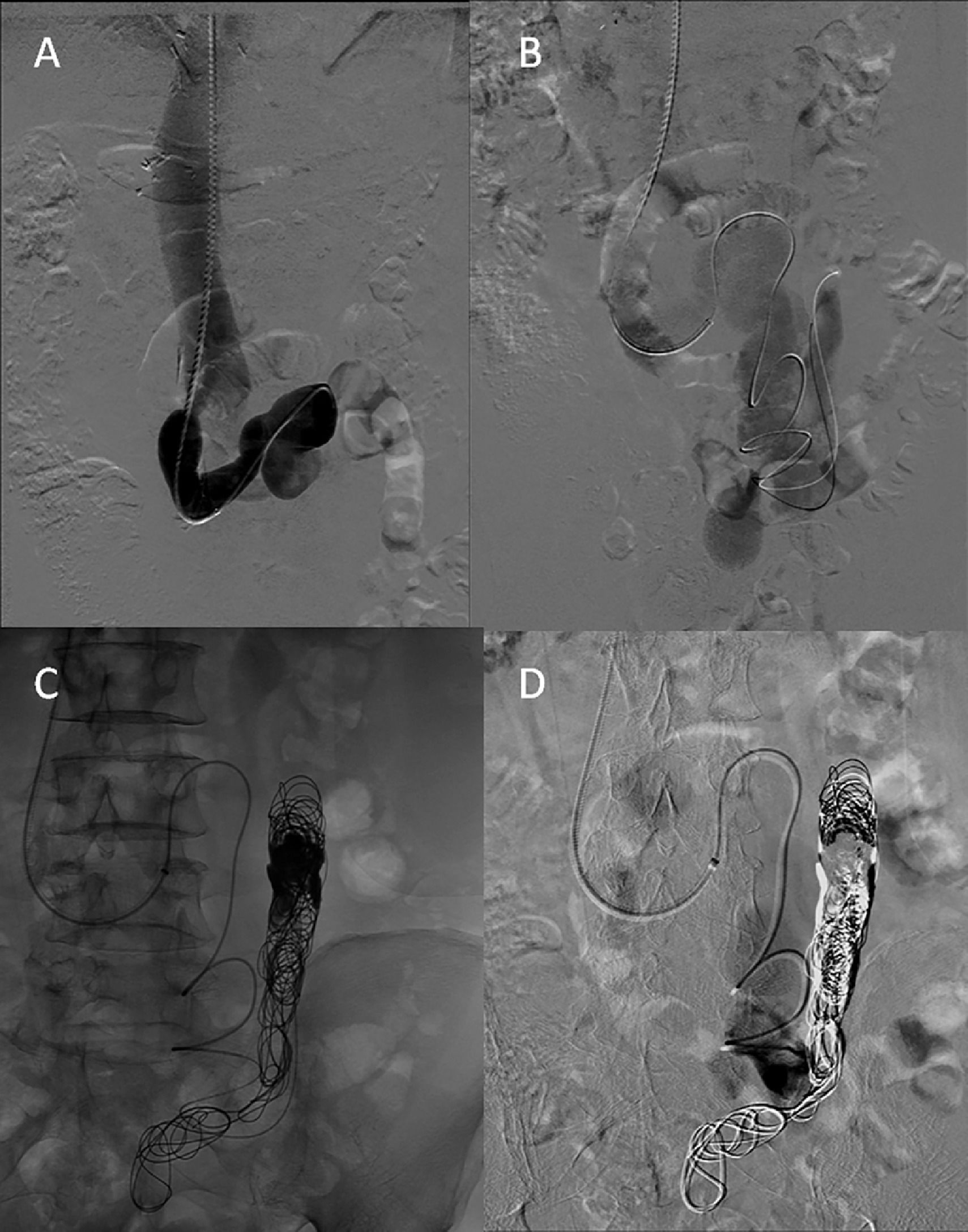 Spontaneous portosystemic shunt embolization in liver transplant ...