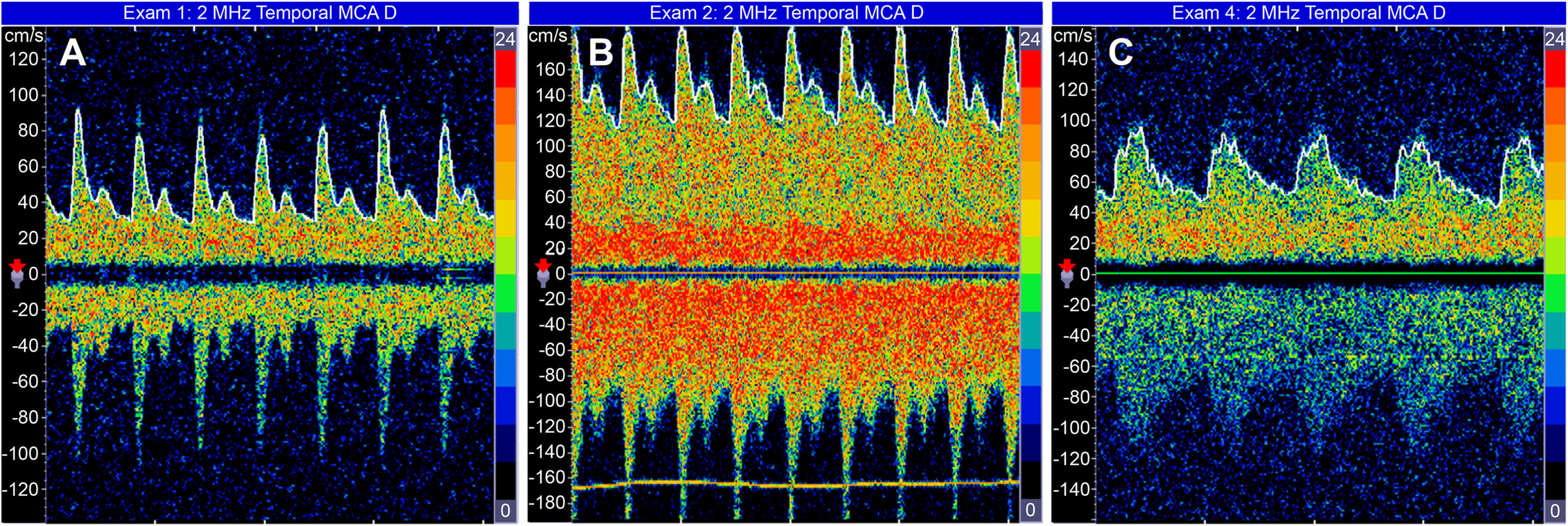 TCD assessment in fulminant hepatic failure: Improvements in cerebral ...