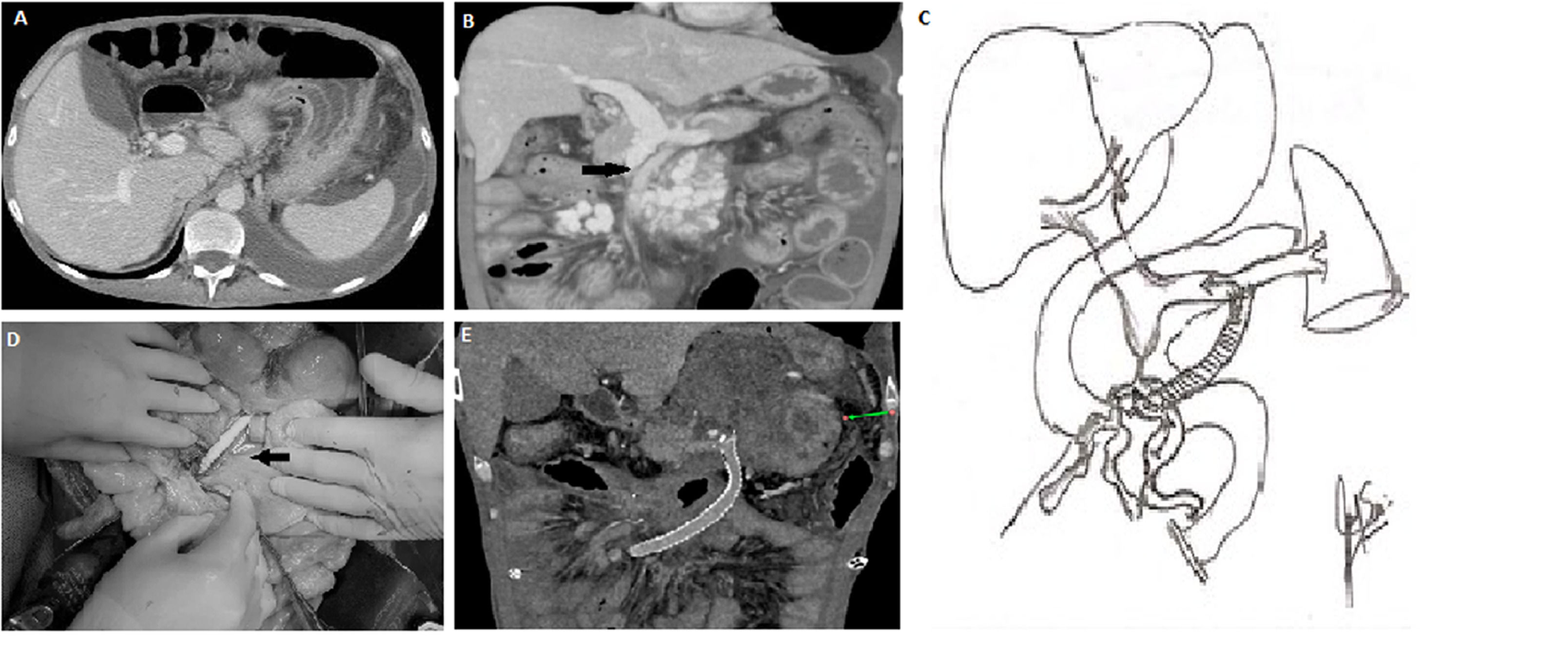 Pathophysiology of ascites: The importance of the intestine. A surgical ...