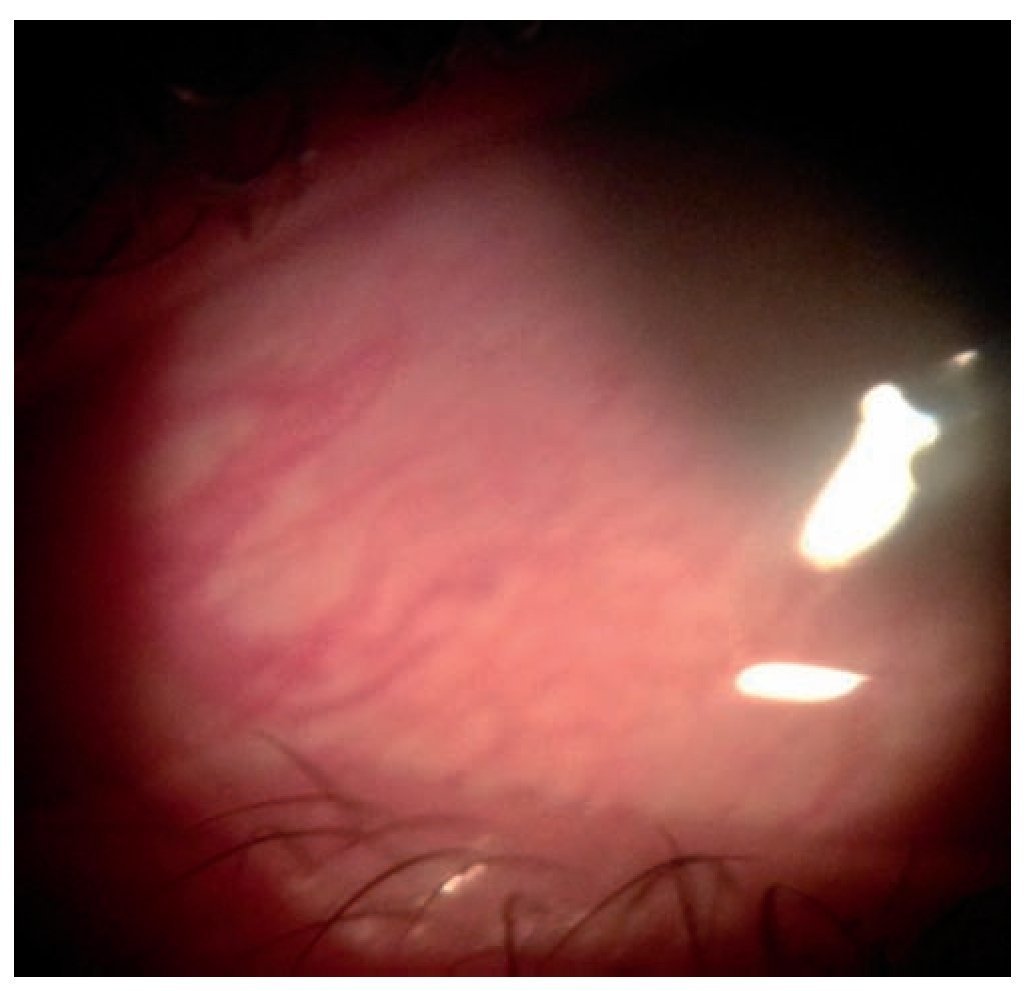 External ophthalmomyiasis by Oestrus ovis treated with tobacco ...