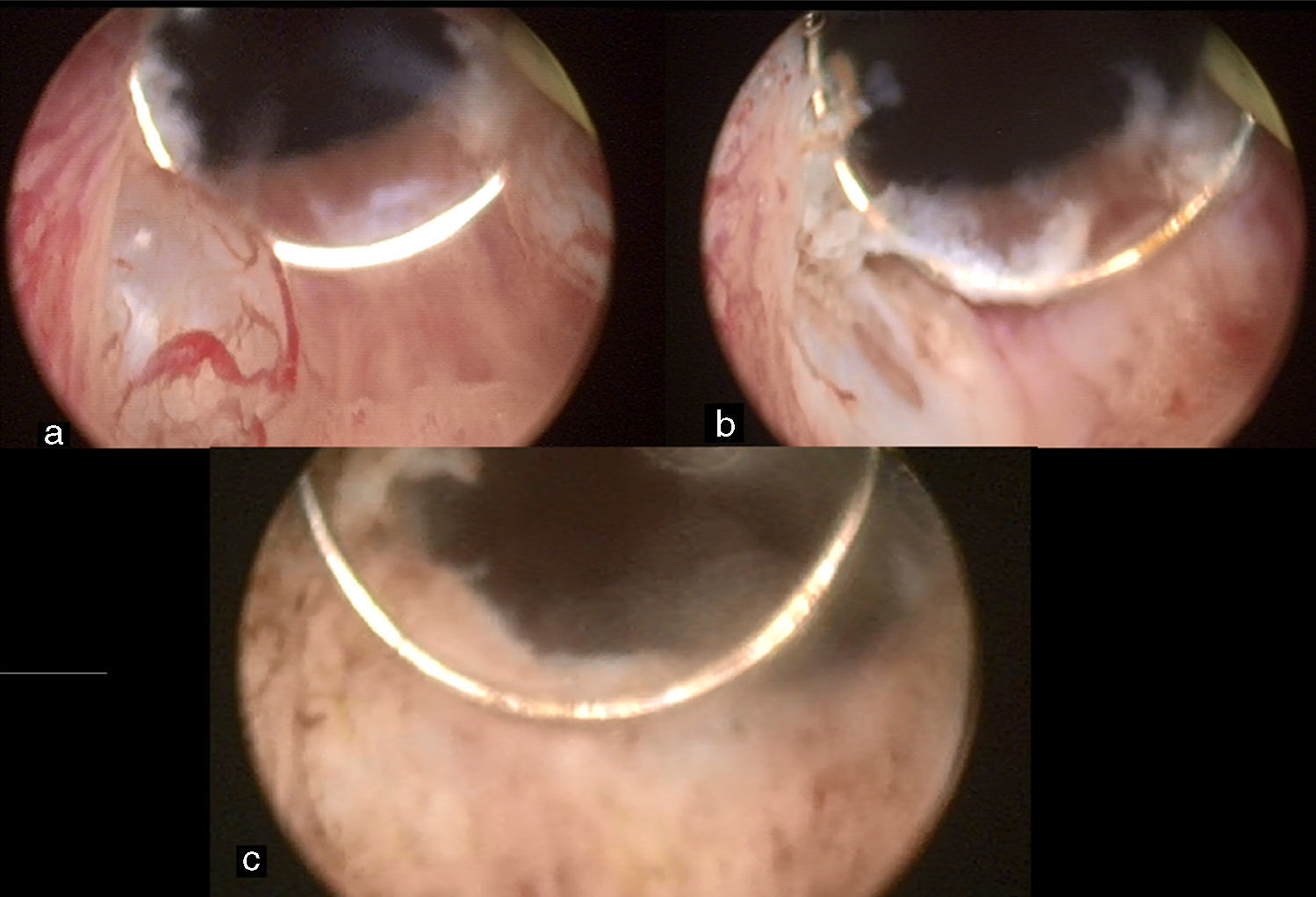 benign cyst prostate