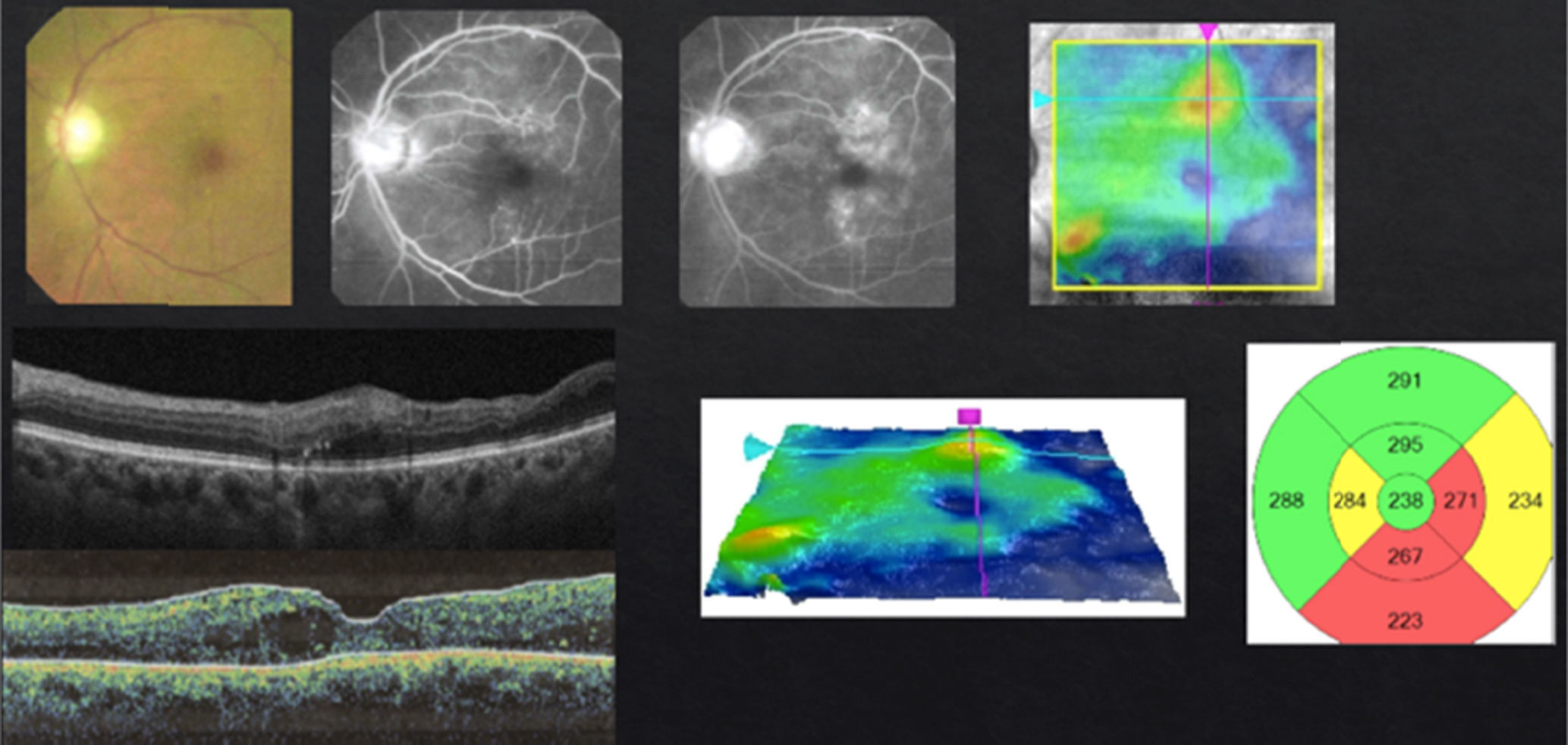 Treatment of Diabetic Macular Edema (DME): Shifting paradigms ...