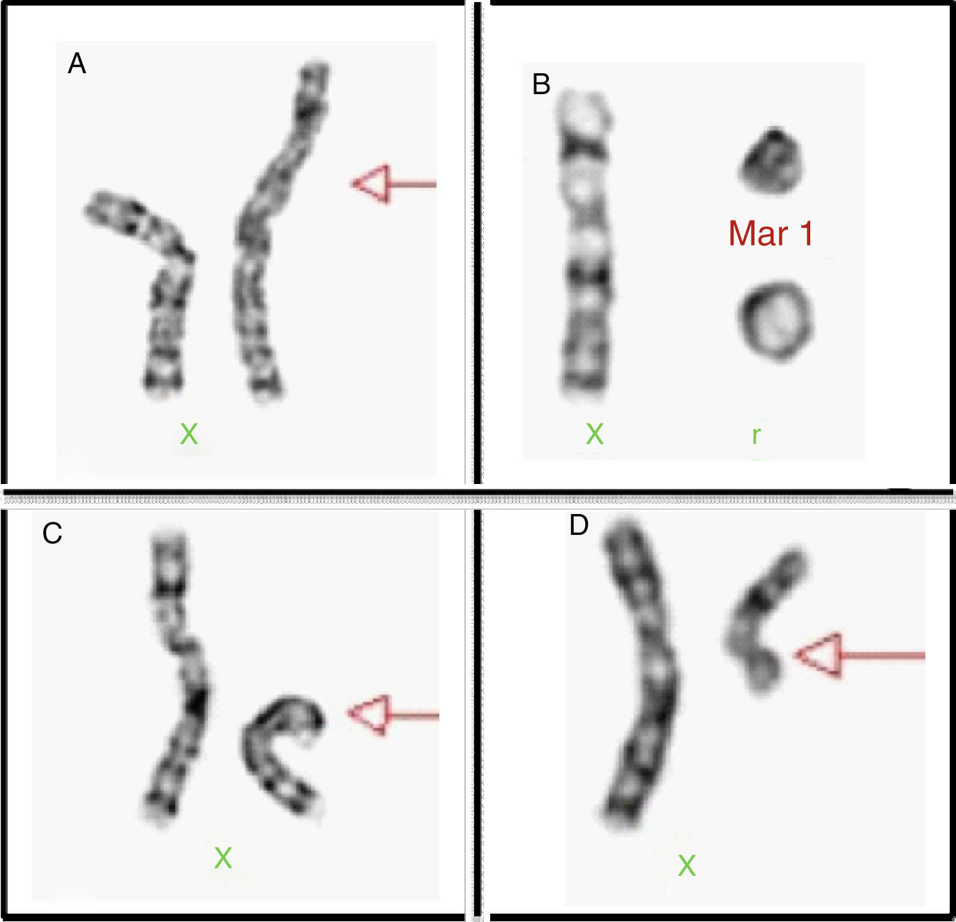 Clinical And Genetic Aspects Of Turner s Syndrome Medicina Universitaria Clinical And Genetic Aspects Of Turner s Syndrome Medicina Universitaria