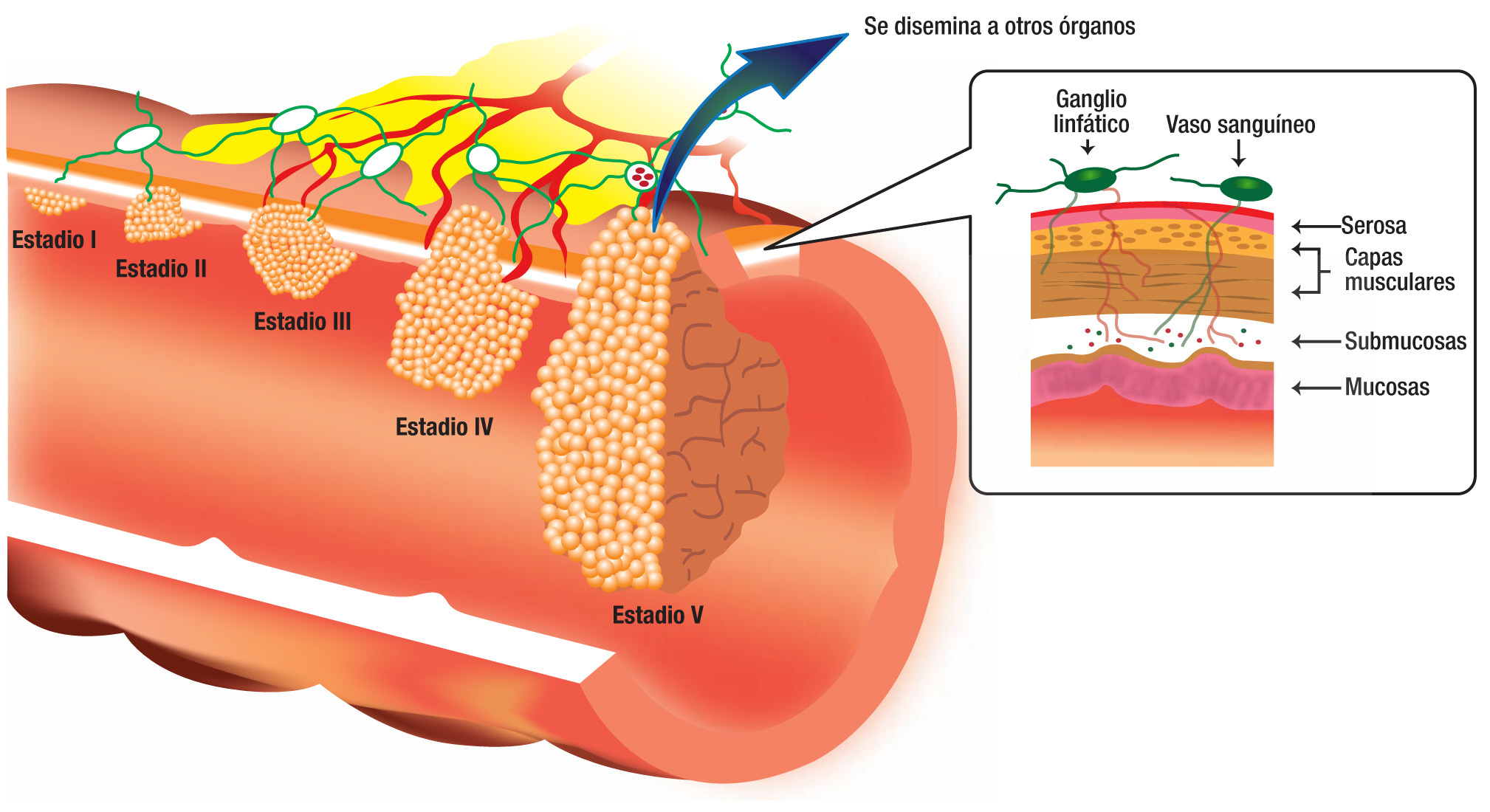 La evaluación del cáncer colorrectal por tomografía computarizada ...