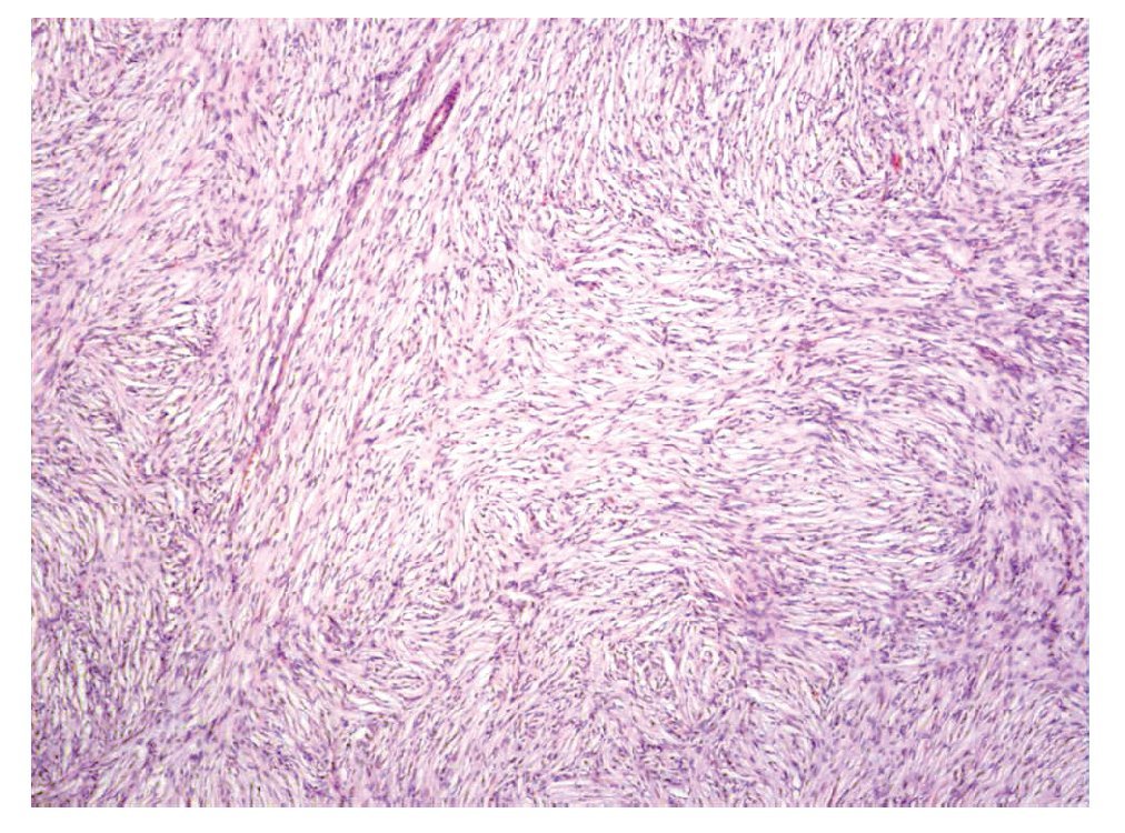 Dermatofibrosarcoma Protuberans. Análisis clínico-patológico de 90 ...