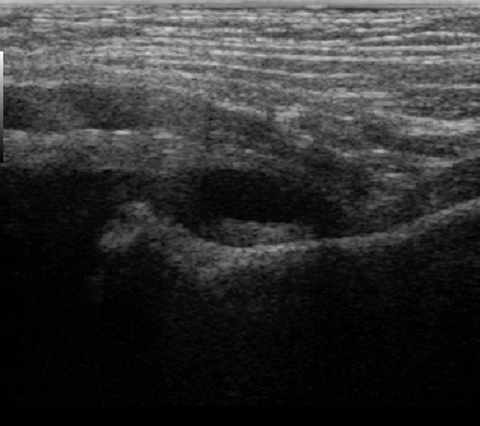 Diferenciación de sinovitis transitoria y artritis séptica de cadera ...