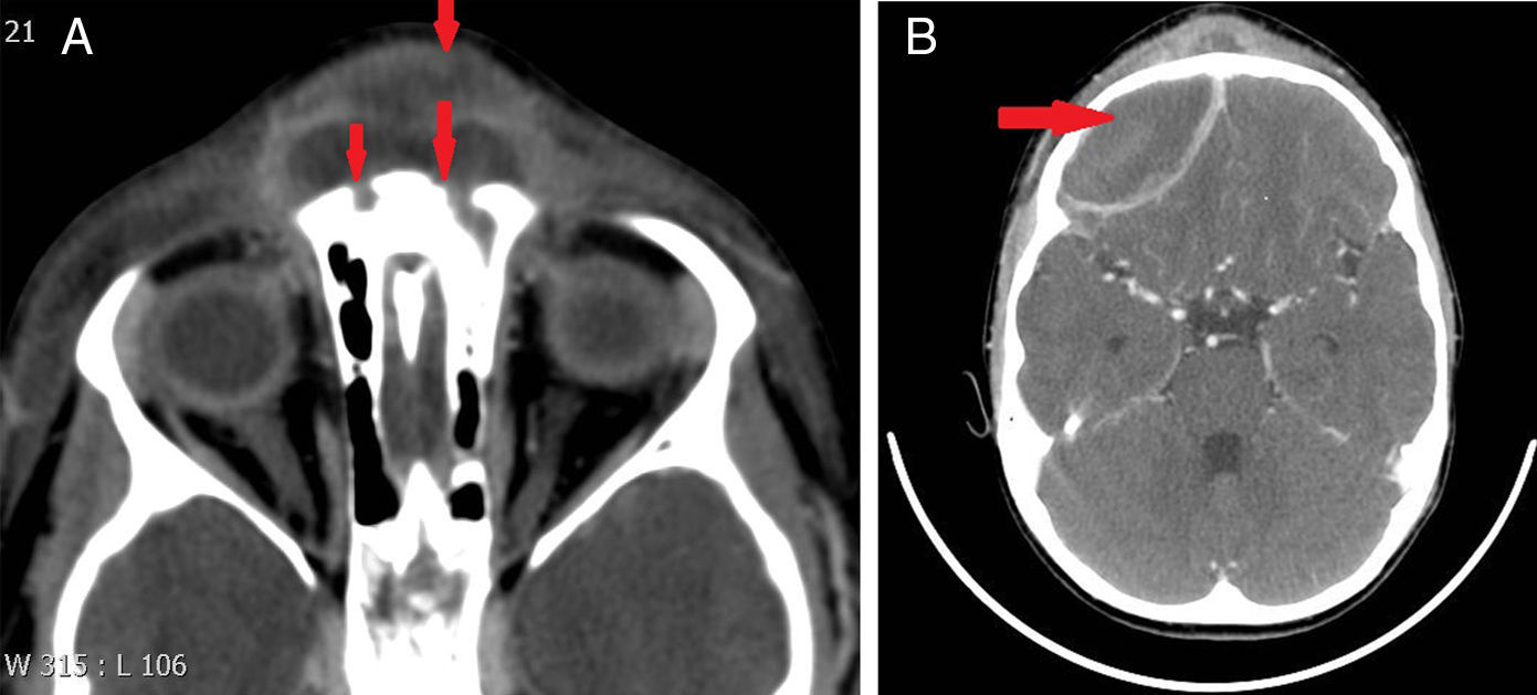 Tumor edematoso de Pott, ¿una entidad olvidada? | Anales de Pediatría
