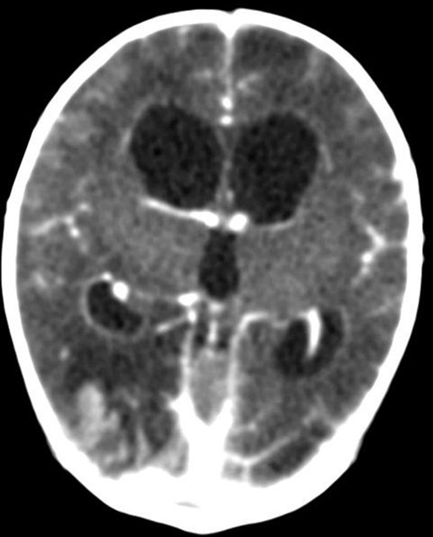 Lesiones secundarias a meningitis neonatal por salmonella | Anales de ...