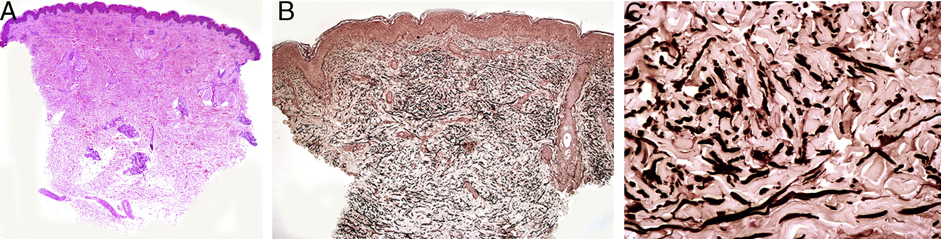 Síndrome de Buschke-Ollendorff | Anales de Pediatría