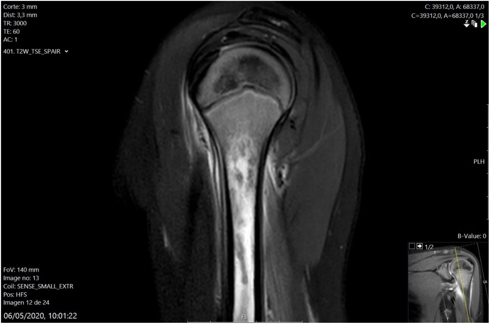 Infarto humeral diafisario en paciente con anemia falciforme | Anales ...