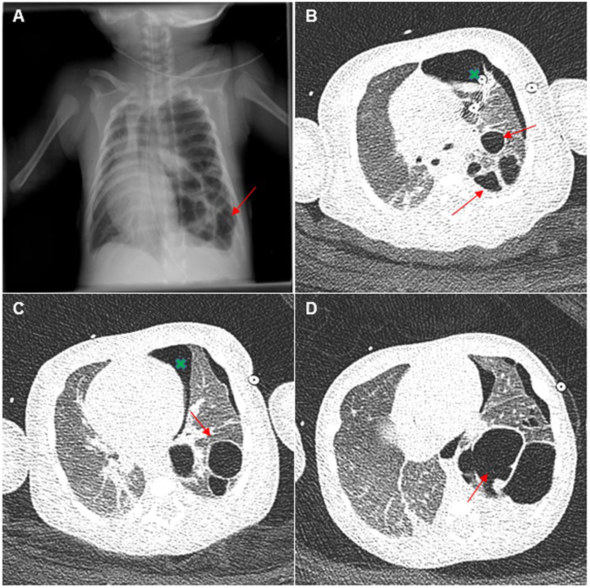 Ecografía pulmonar neonatal: diagnóstico precoz de neumonía ...