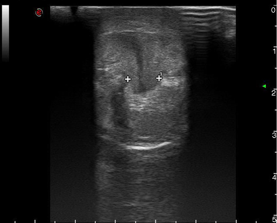 Ecografía Vascular Del Pene