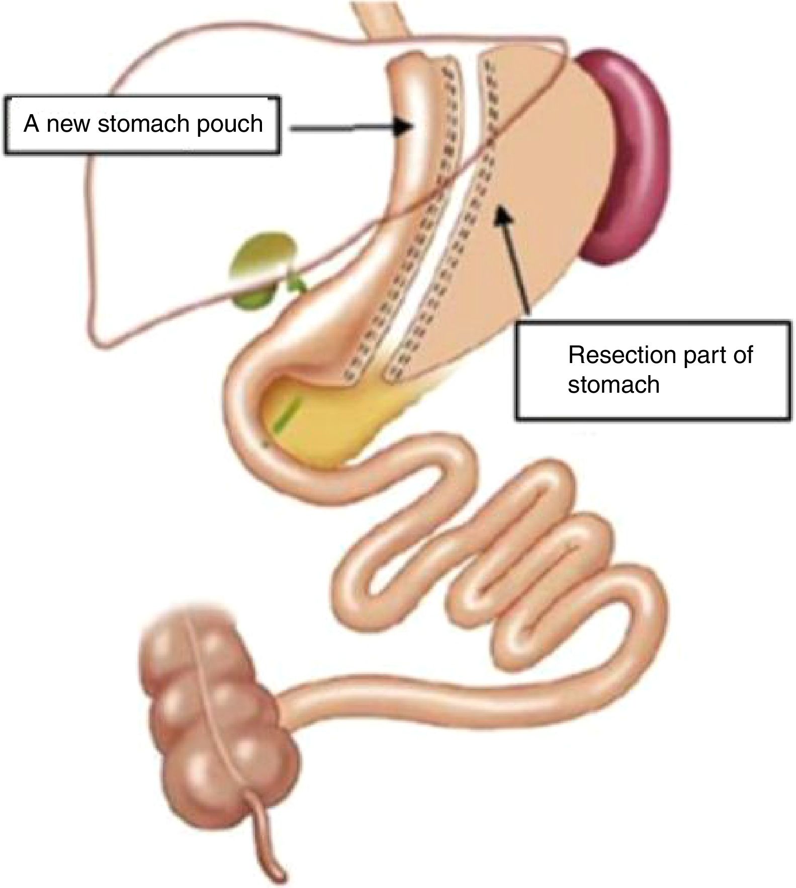 total gastrectomy steps