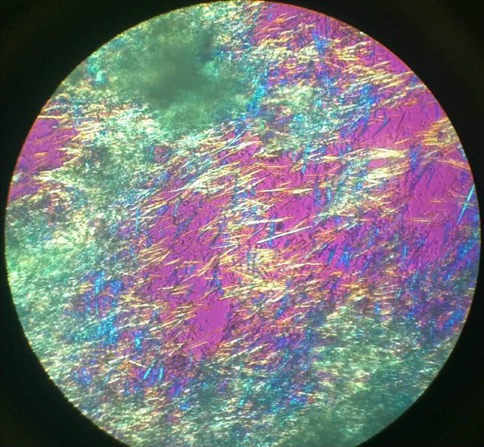 Ataque agudo de gota sospechoso de artritis infecciosa | Reumatología ...