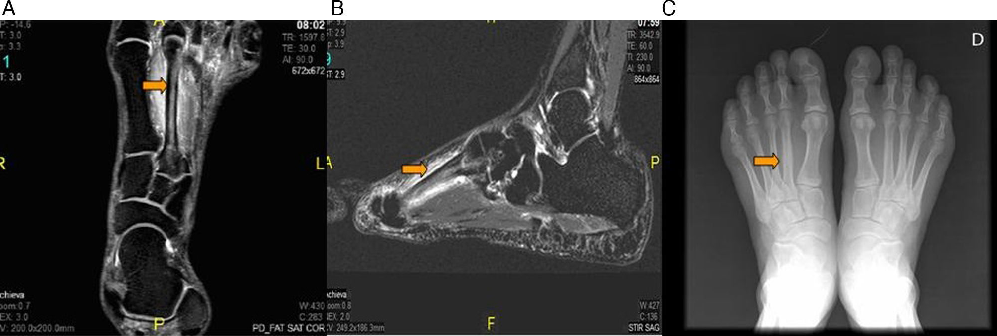 Fracturas de fatiga de repetición en pies en un paciente tratado con ...