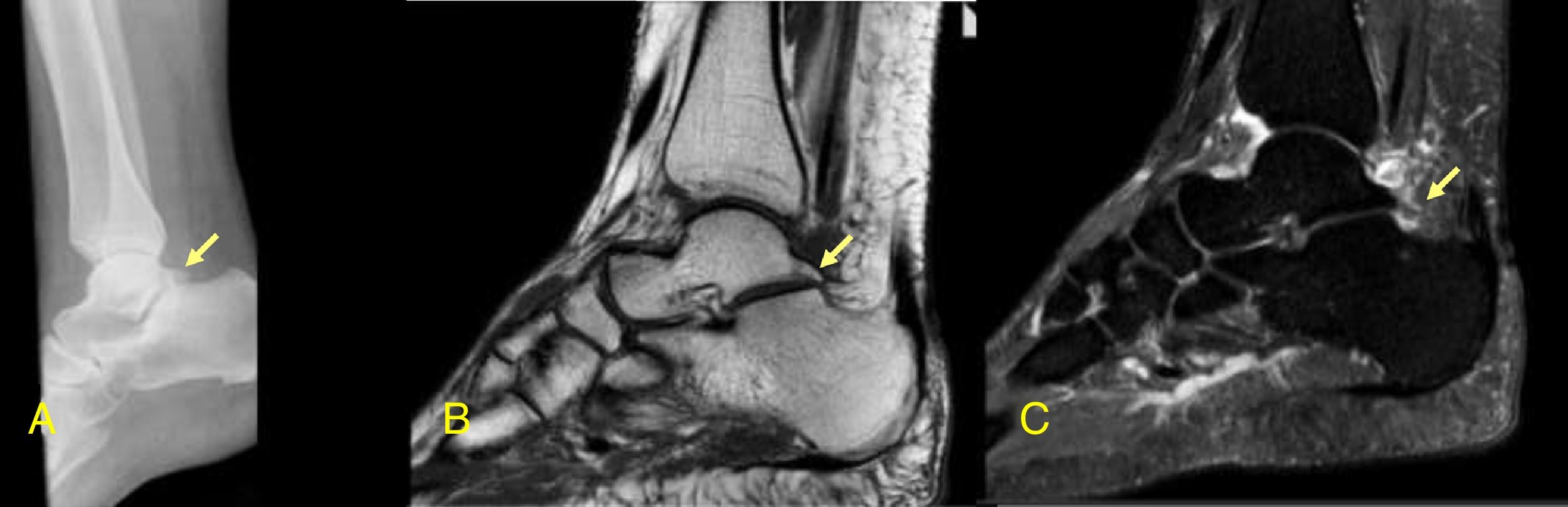 Posterior Ankle Impingement Syndrome | Reumatología Clínica