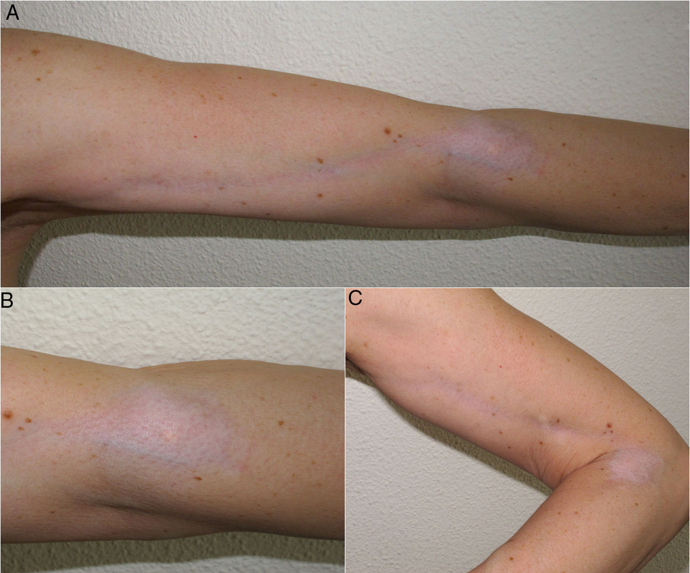 Atrofia e hipopigmentación lineal cutánea por inyección intraarticular ...