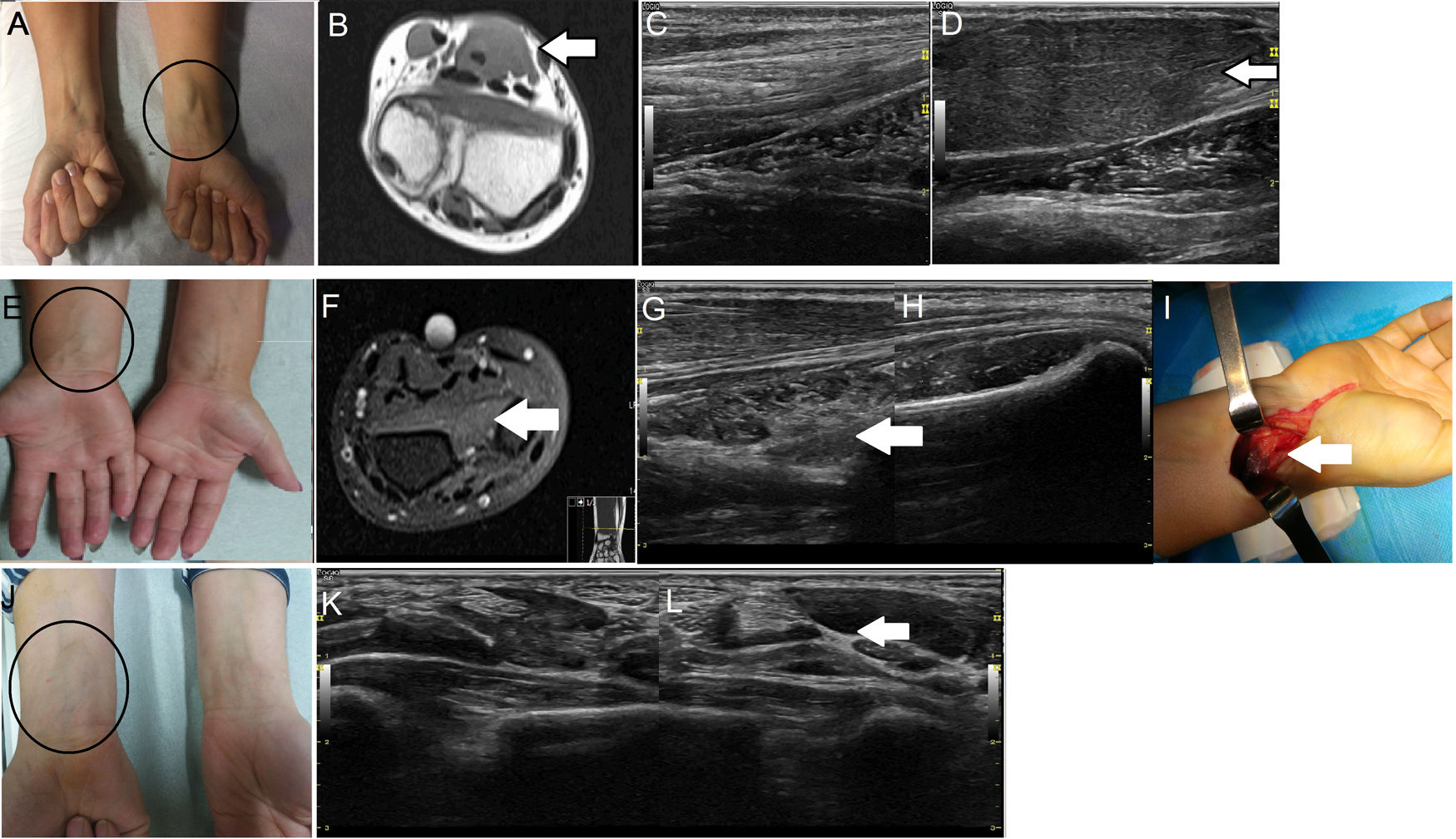 Uncommon causes of nerve compression in the distal forearm ...