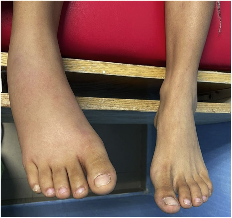 Enfermedad gonocócica diseminada en pediatría: reporte de caso y ...