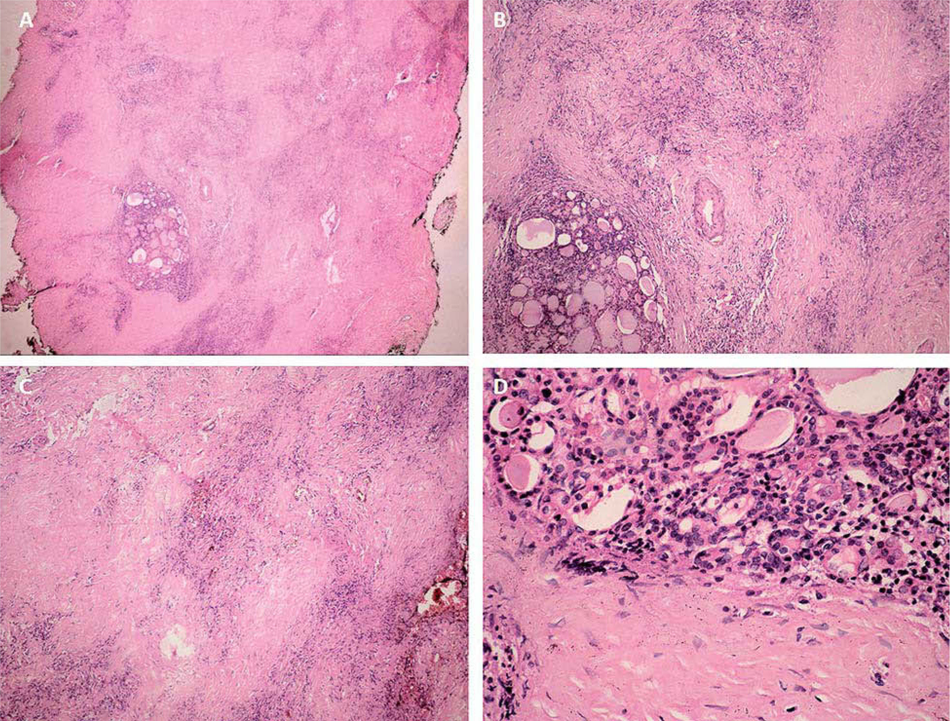 Tiroiditis de Riedel | Revista Española de Patología