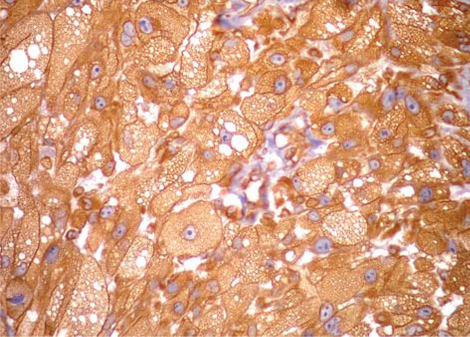 Fibroxantoma atípico de células claras: variante infrecuente de ...