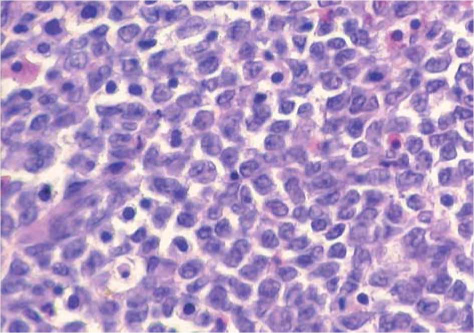 Sarcoma mieloide de intestino delgado en paciente aleucémico | Revista ...