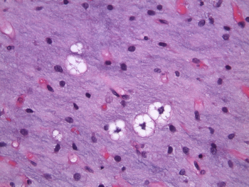Liposarcoma mixoide de mama. A propósito de un caso y revisión de la ...