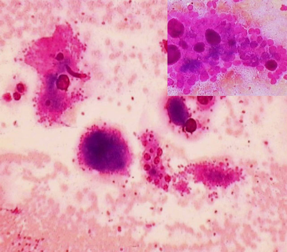 Adenoid cystic carcinoma of Bartholin's gland—A rare entity likely to ...