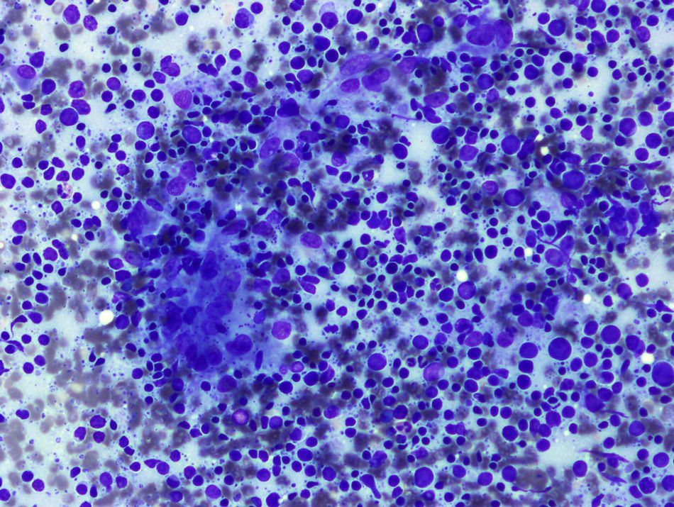 Linfadenitis cervical aislada por leishmaniasis con patrón «Piringer ...