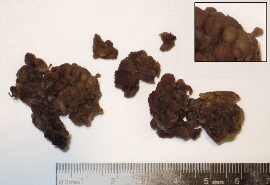 Hiperplasia Nodular Oncocítica Multifocal De Glándula Parótida A