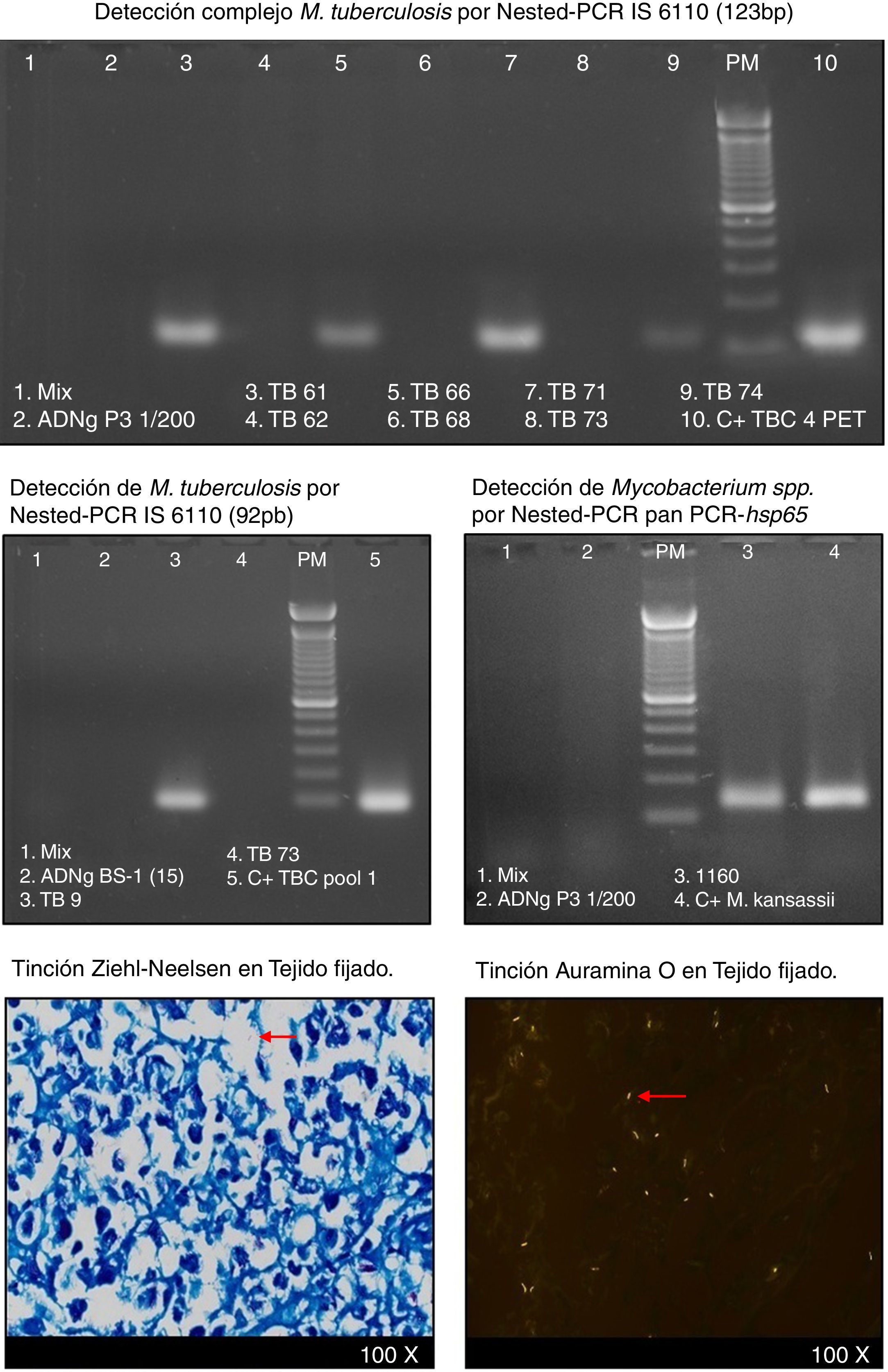 Diagnóstico diferencial de tuberculosis en base a PCR en lesiones ...