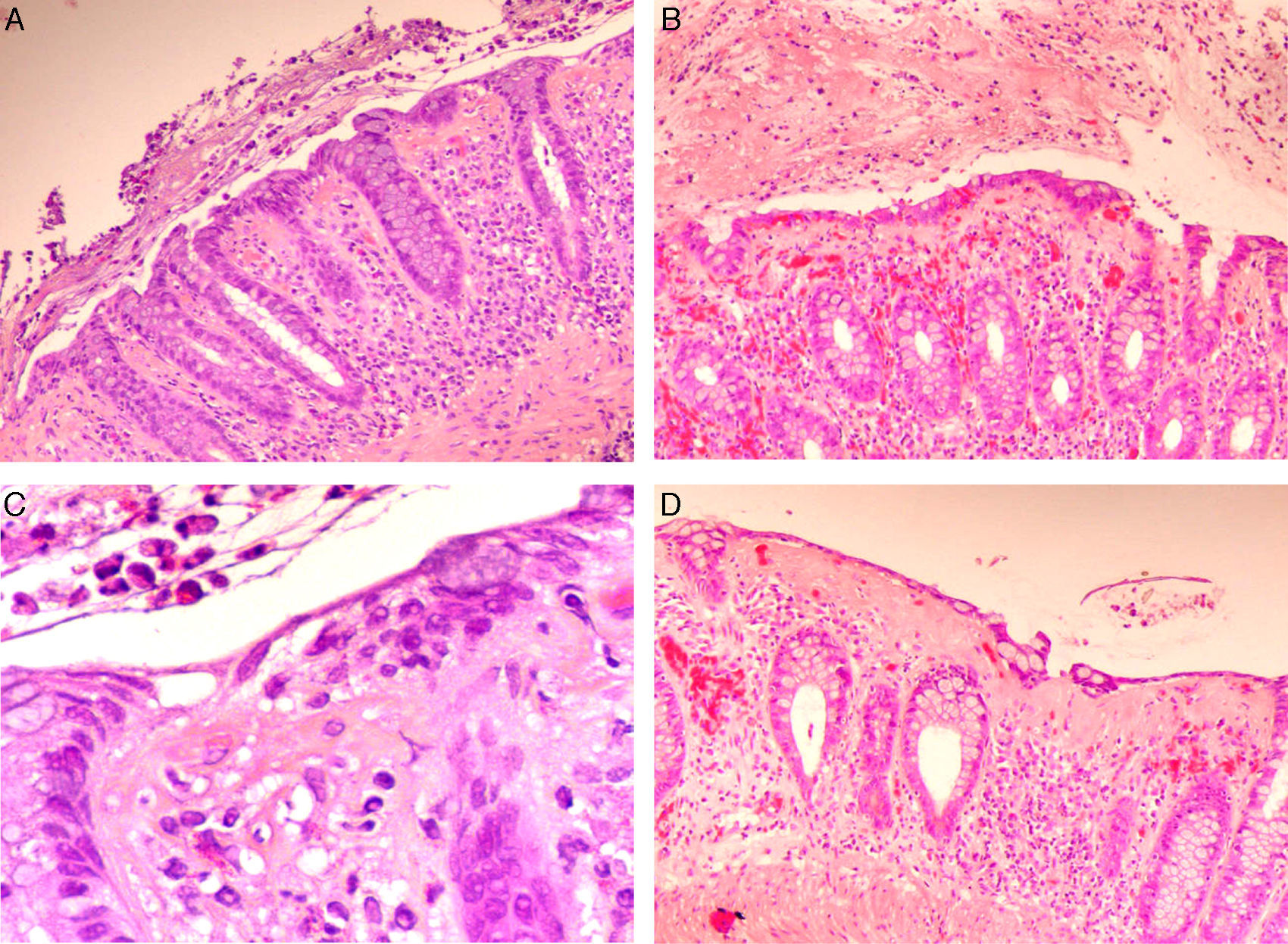 Colitis microscópica atípica: descripción de 2 casos de colitis ...