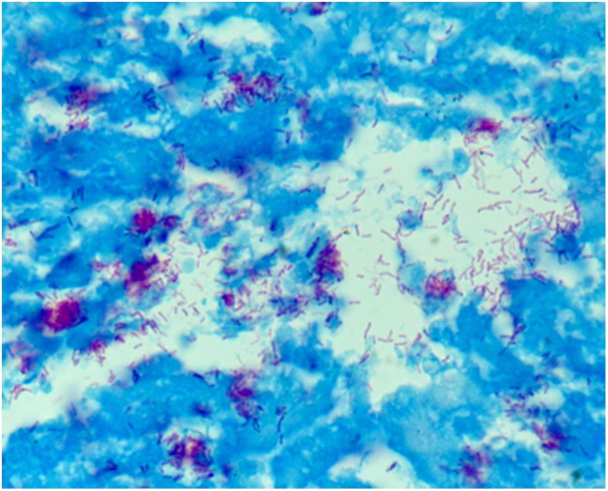 Tuberculosis en estudios post mortem: estudio observacional de 10 años ...