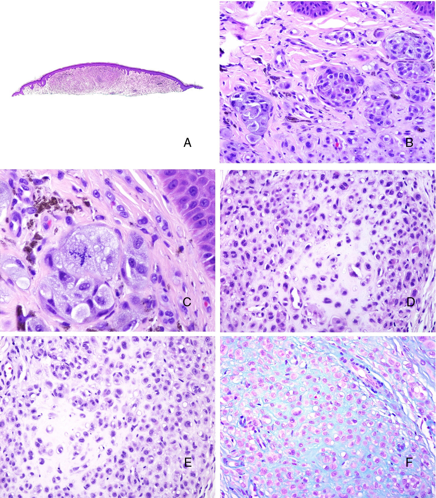 Chondroid atypical spitzoid melanocytic tumor | Revista Española de ...