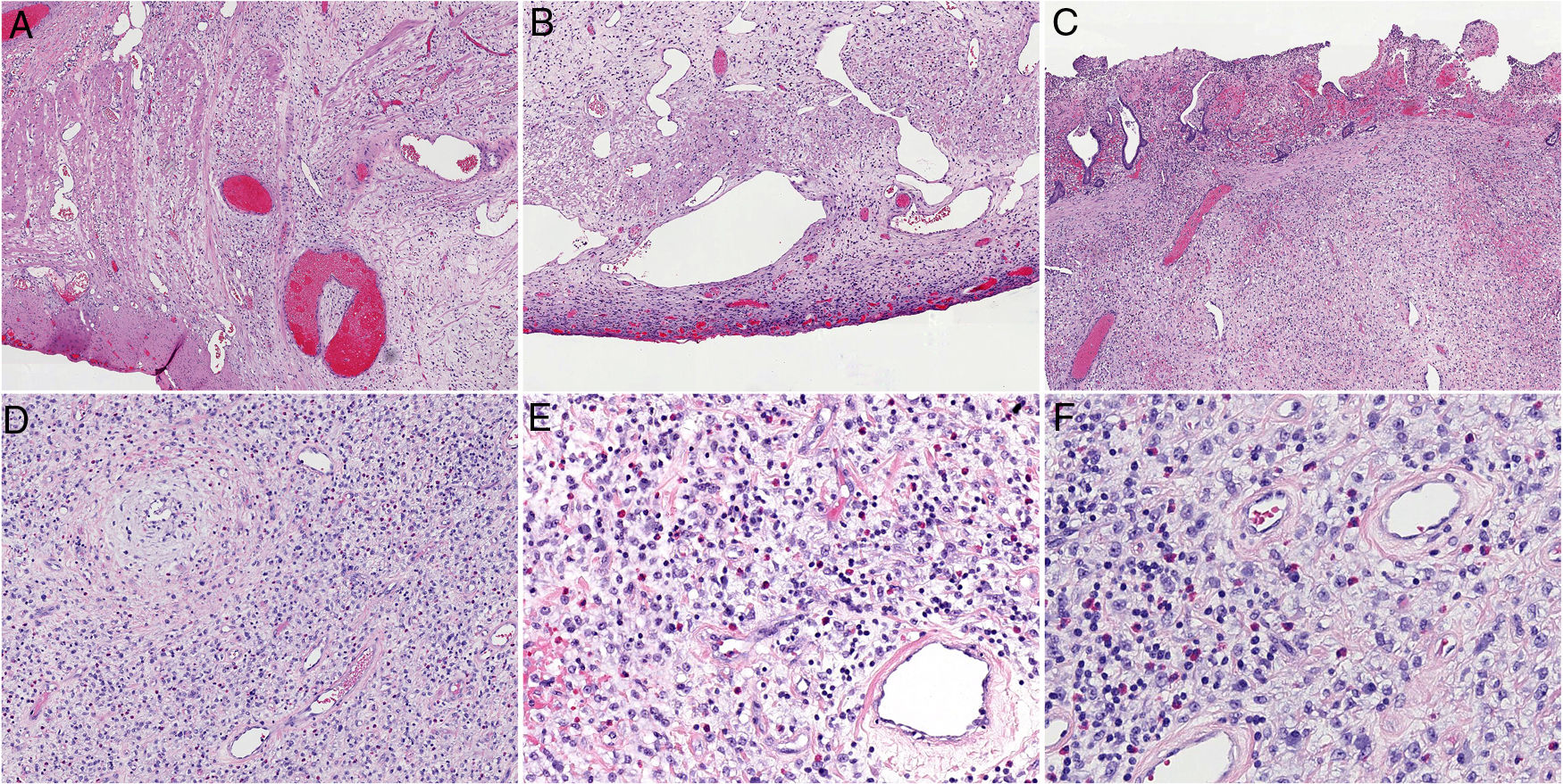 Ileal Intussusception in an Adult Caused by a Locally Invasive ...