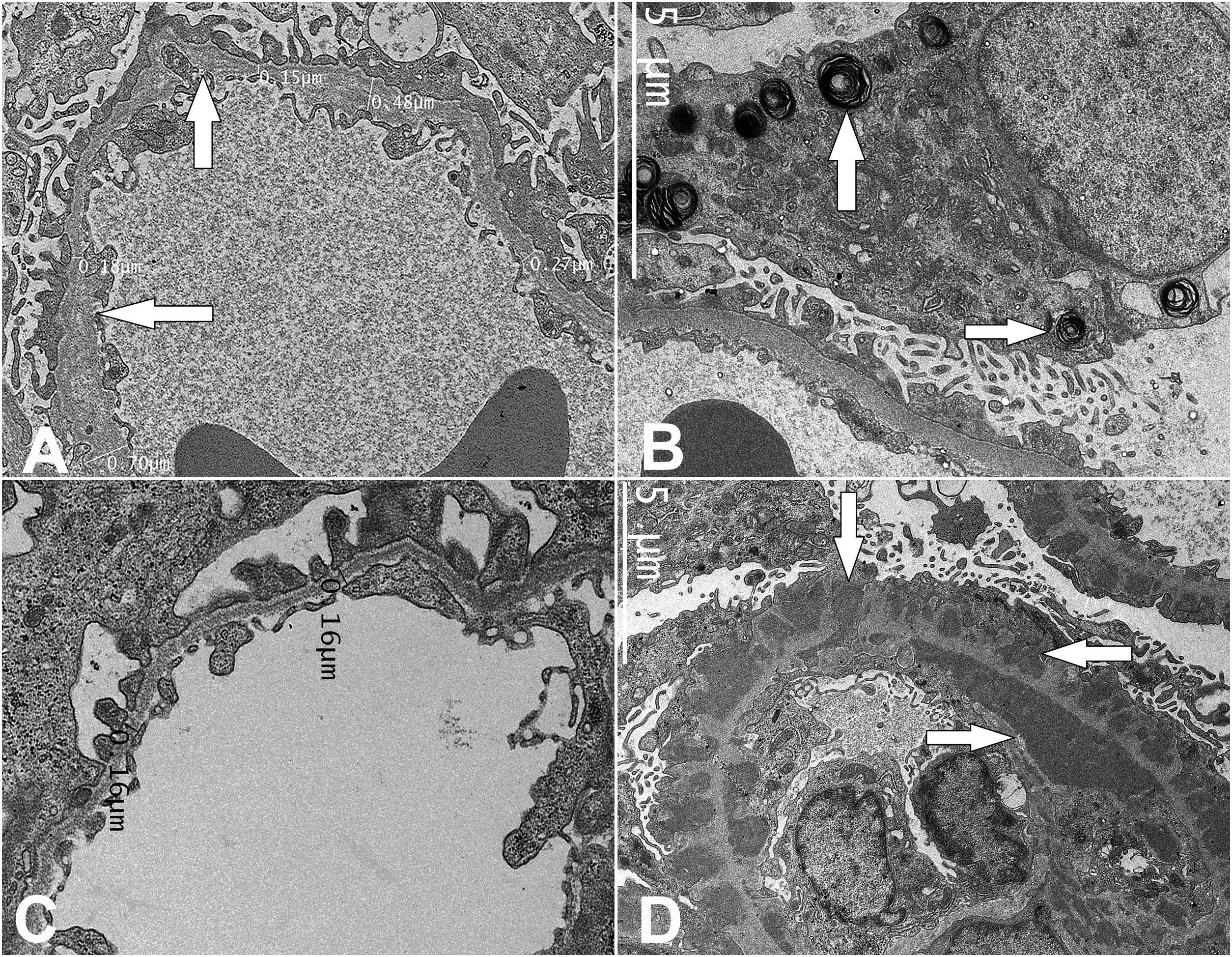 Microscopía electrónica en biopsias renales: una evaluación de su ...