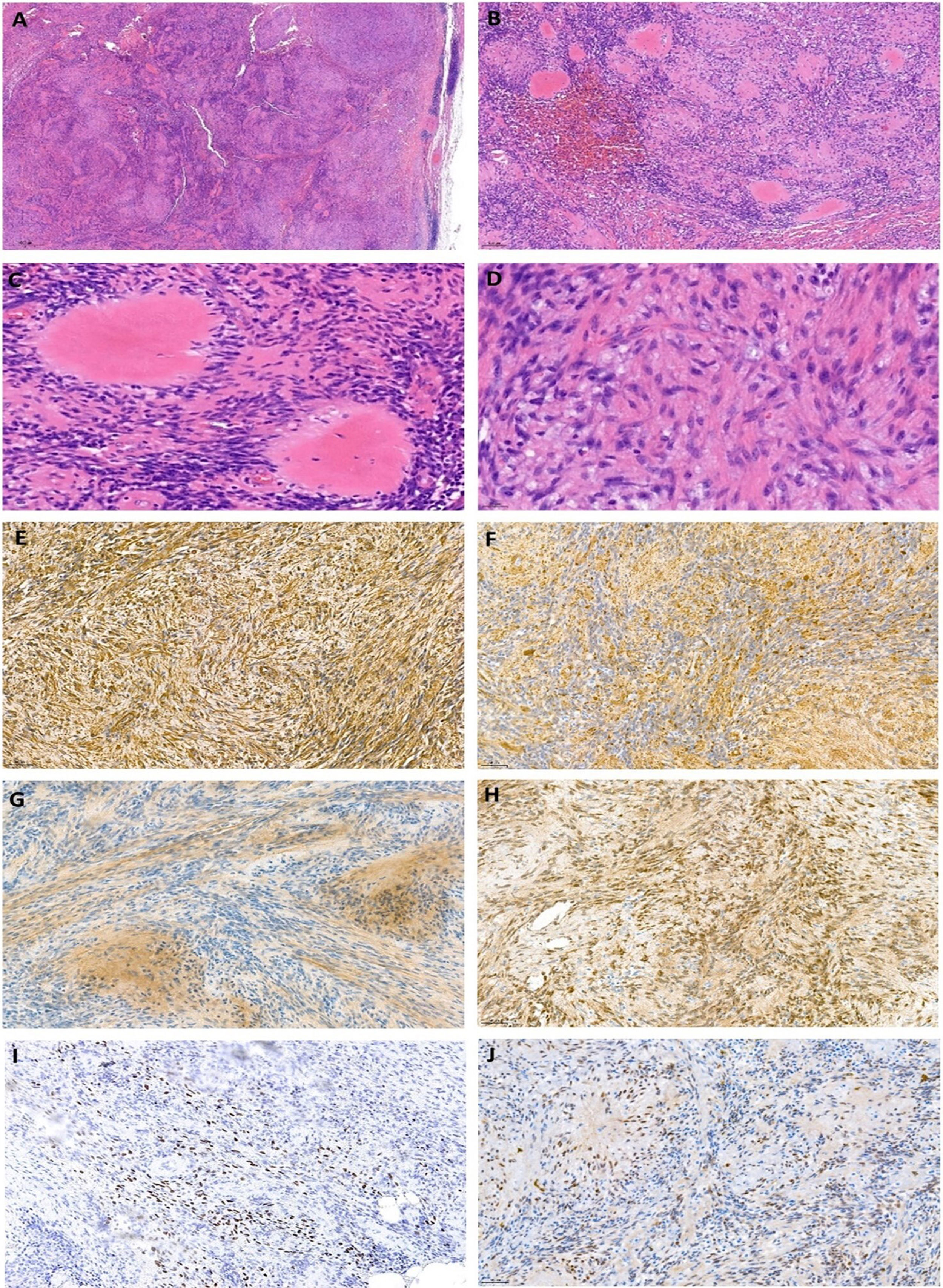 CTNNB1 somatic mutations drive Wnt pathway activation in a case of ...