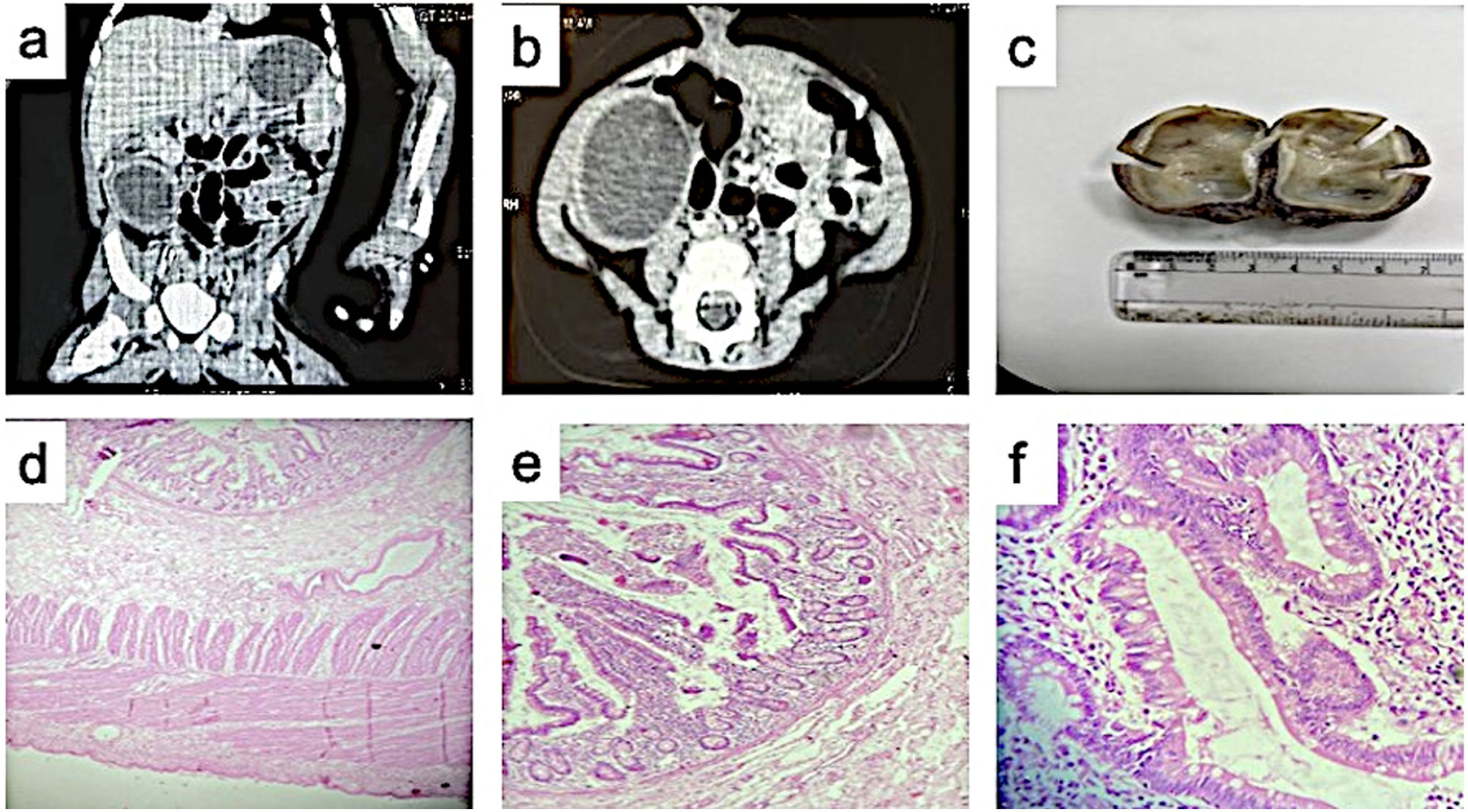 Enteric duplication cysts in paediatric population along with ...