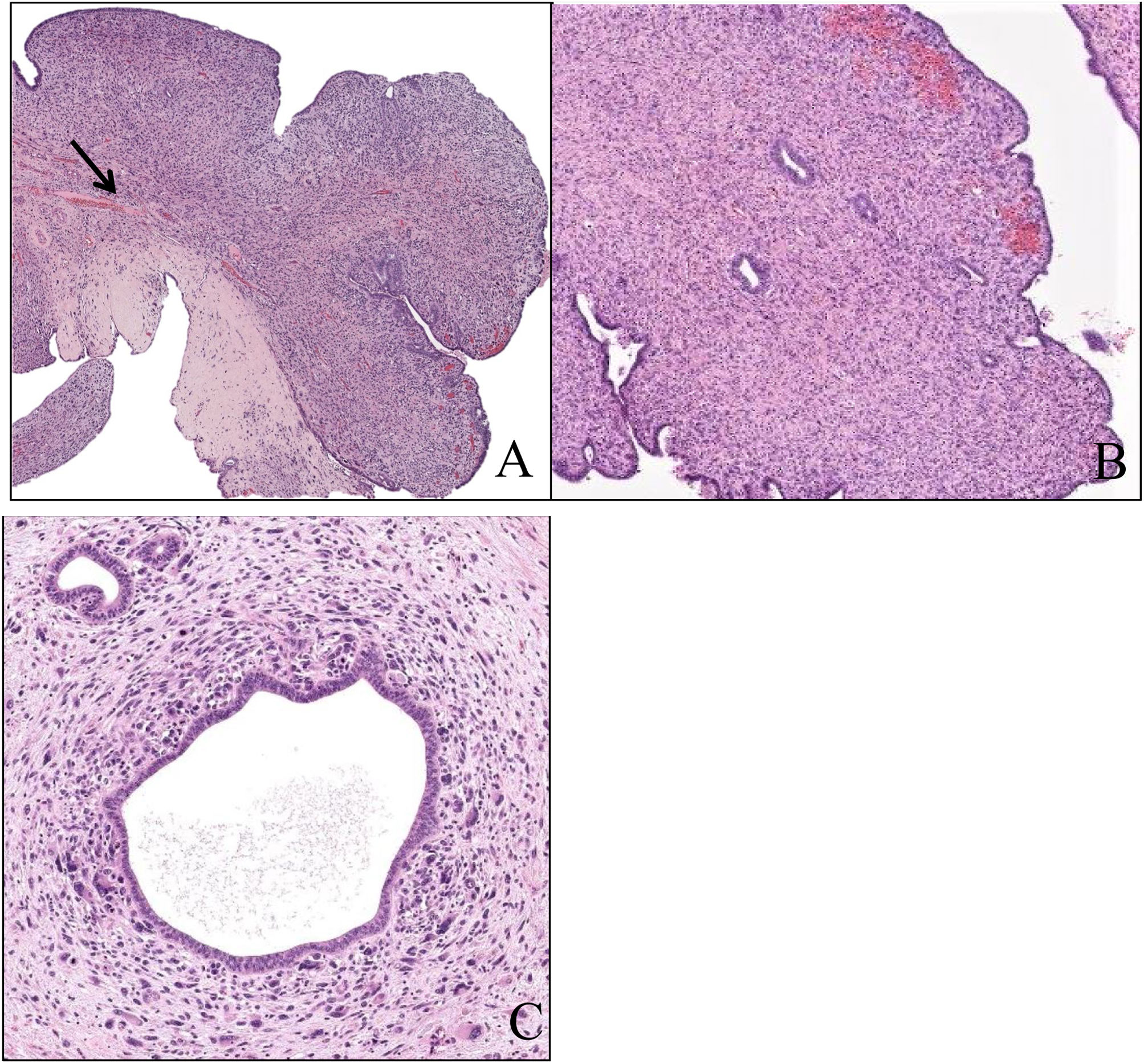 Müllerian adenosarcoma with sarcomatous overgrowth and heterologous ...