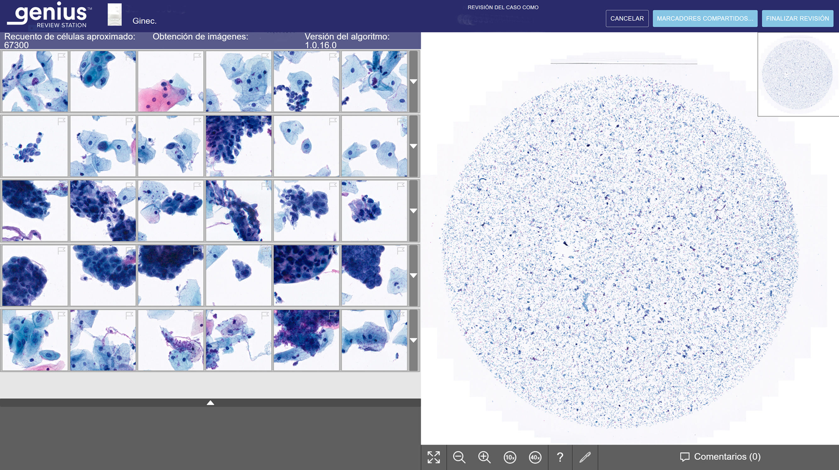 Validation of digital image slides for diagnosis in cervico-vaginal ...