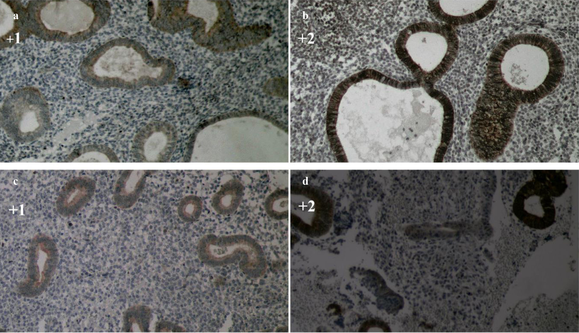 Comparison of B-cell lymphoma 2 (BCL-2) expression in disordered ...