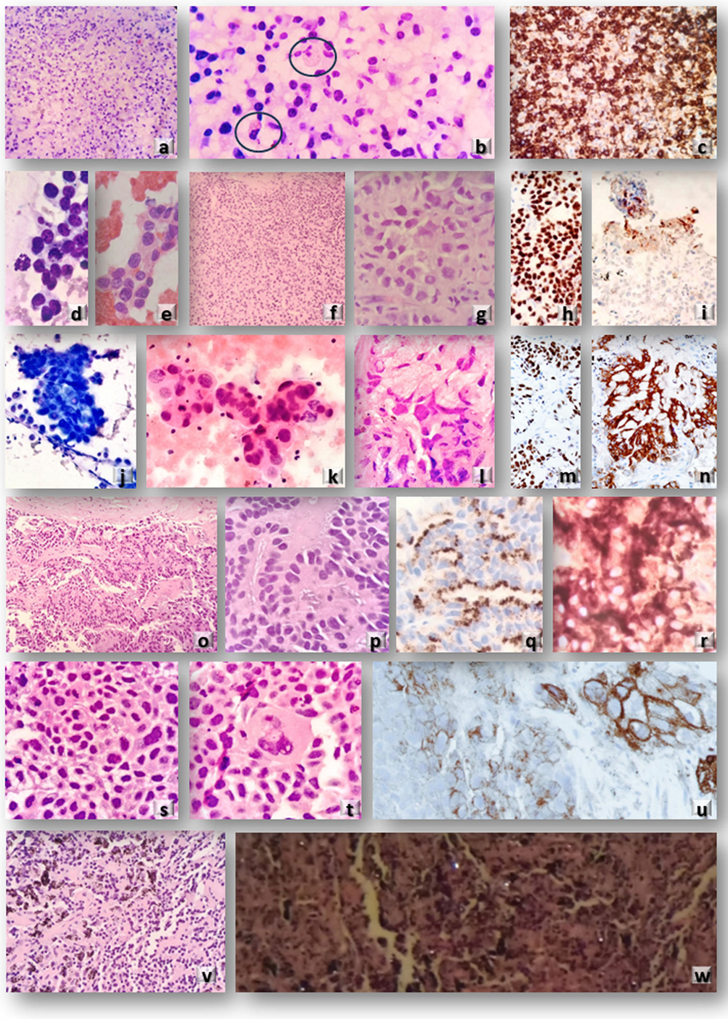 EBUS-TBNA and CryoEBUS of the mediastinal lymph node. One hundred seventy-eight cases ...
