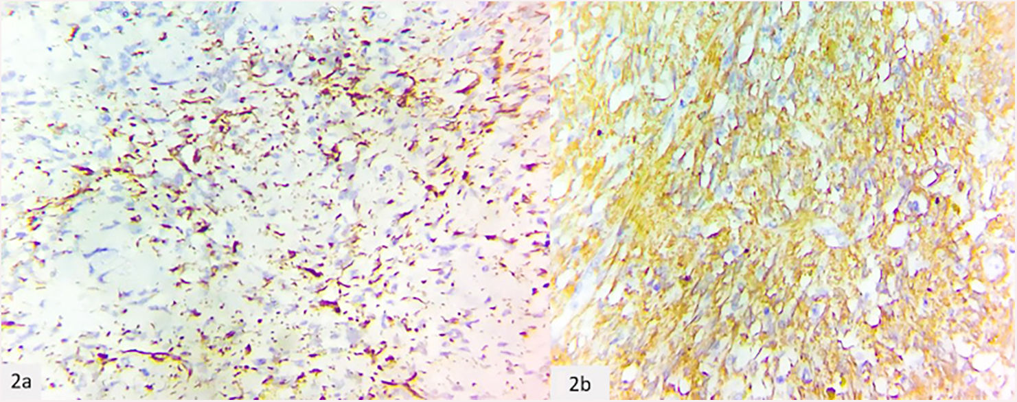 Axillary intranodal palisaded myofibroblastoma, a rare tumour at an ...