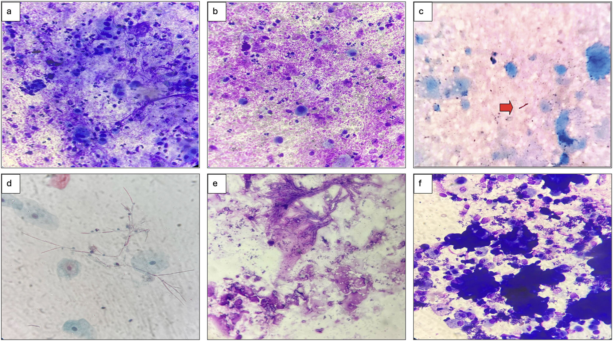 Cytomorphological patterns in bronchoalveolar lavage in the diagnostic ...
