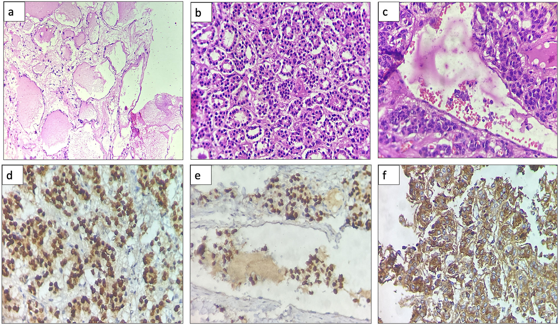 Rare malignant transformation of struma ovarii into follicular thyroid ...